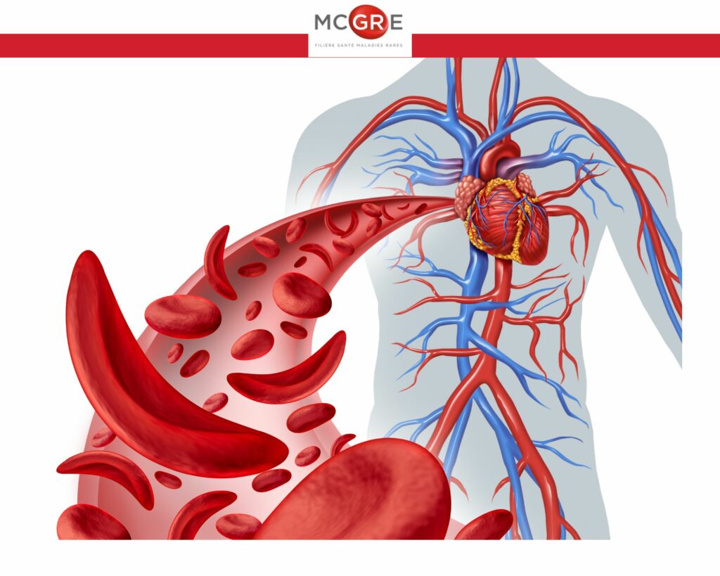Les maladies rares du globule rouge - MCGRE - Filière de santé maladies ...